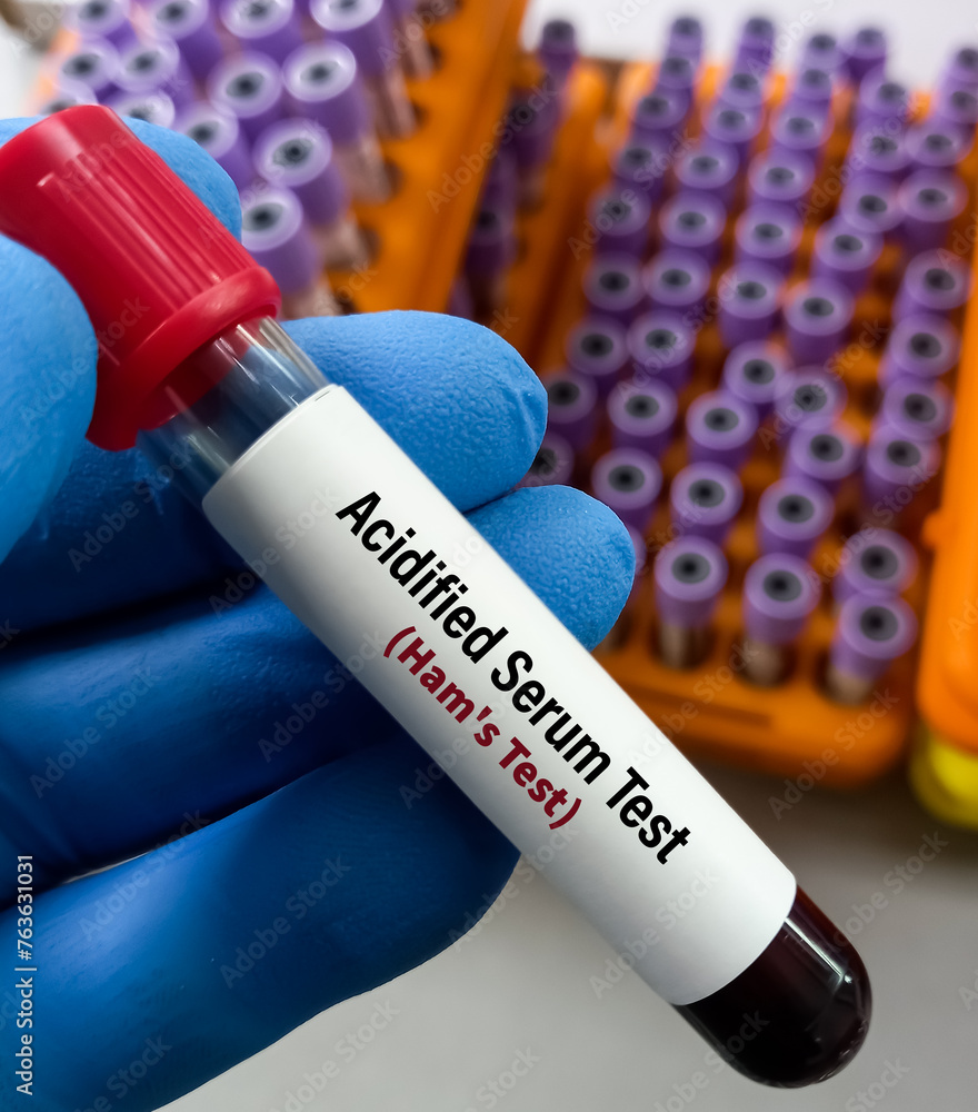 Blood sample for Acidified Serum Test (HAM'S Test) to diagnose ...