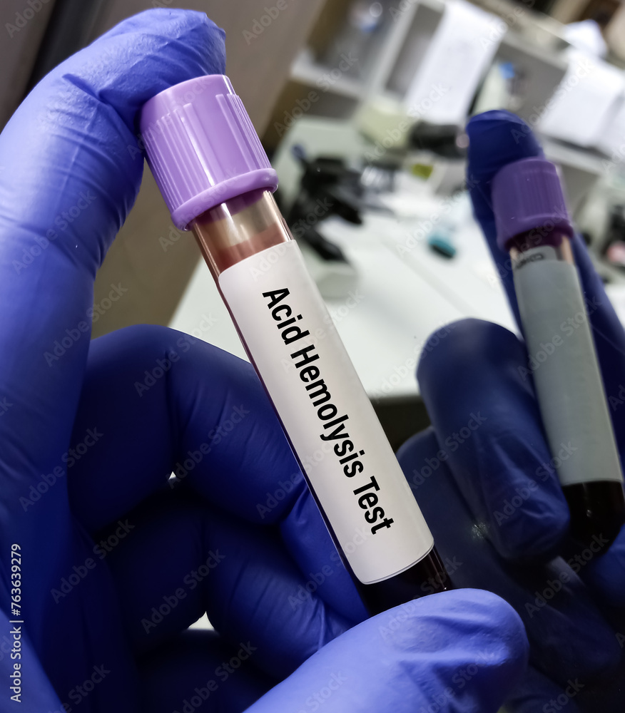 Blood sample for Acid Hemolysis test, to diagnose paroxysmal nocturnal ...