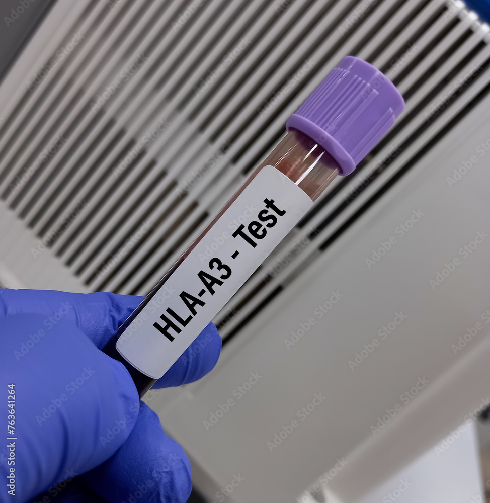 Test tube with blood sample for HLA-A3 (Human Leukocyte Antigen) test ...