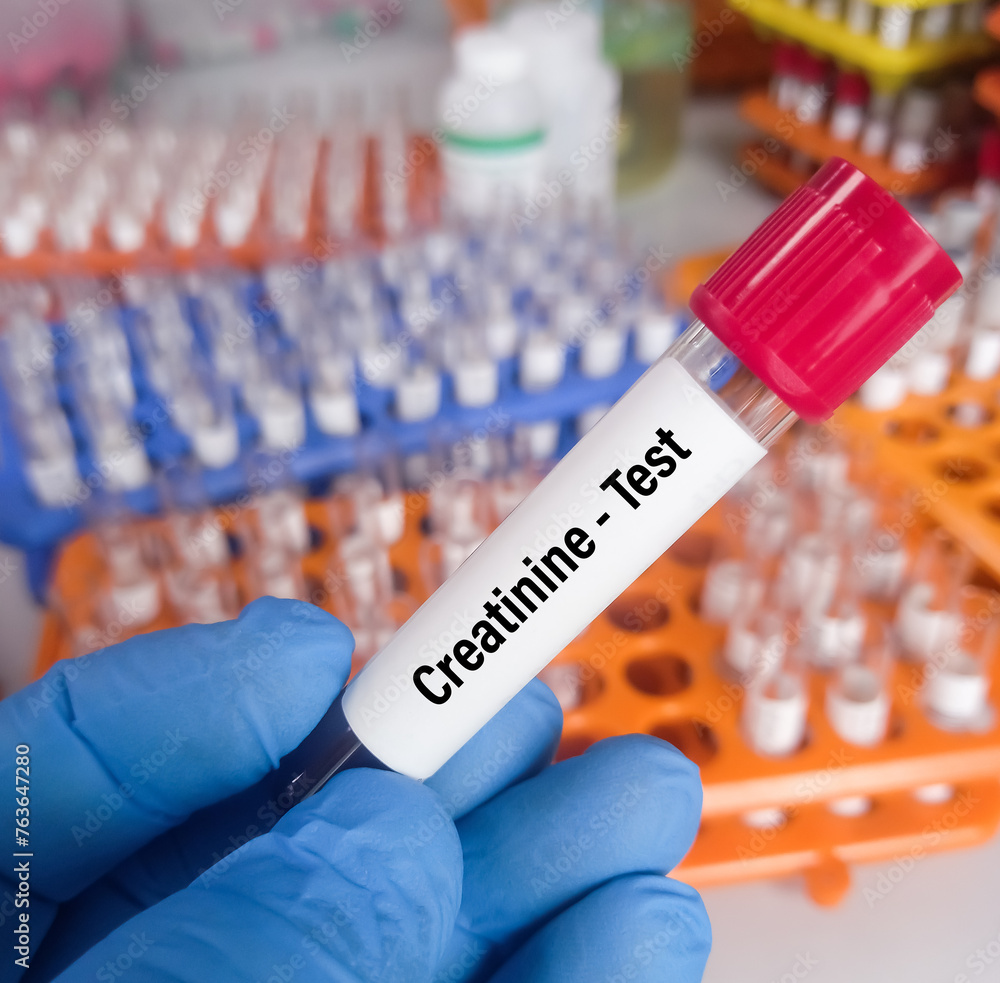 Blood sample for Serum Creatinine test. Diagnosis of kidney or renal ...