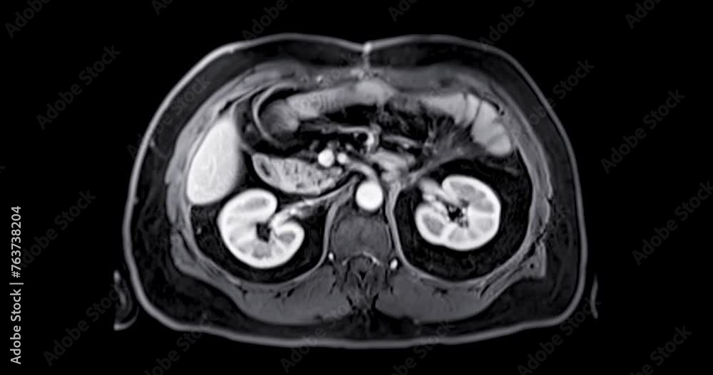 MRI of the upper abdomen axial view is a non-invasive imaging technique ...