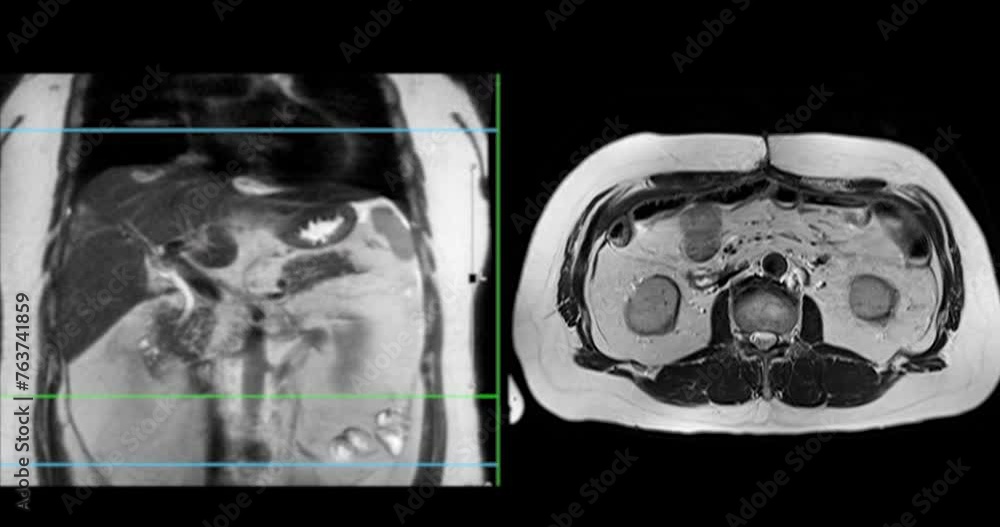 MRI of the upper abdomen axial view is a non-invasive imaging technique ...