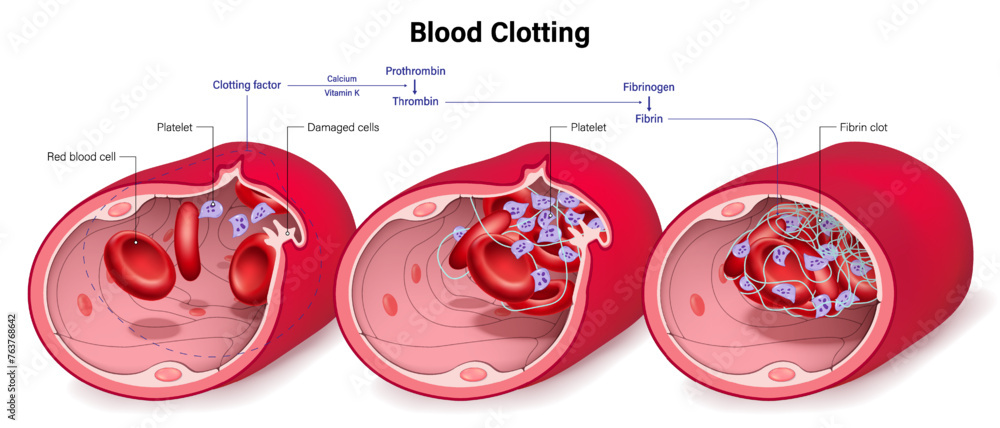Blood clotting process. Damaged blood vessel, Formation of platelet ...