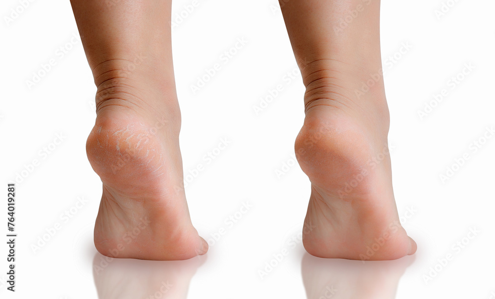 Feet with dry skin before and after treatment, comparison of a dry heel ...