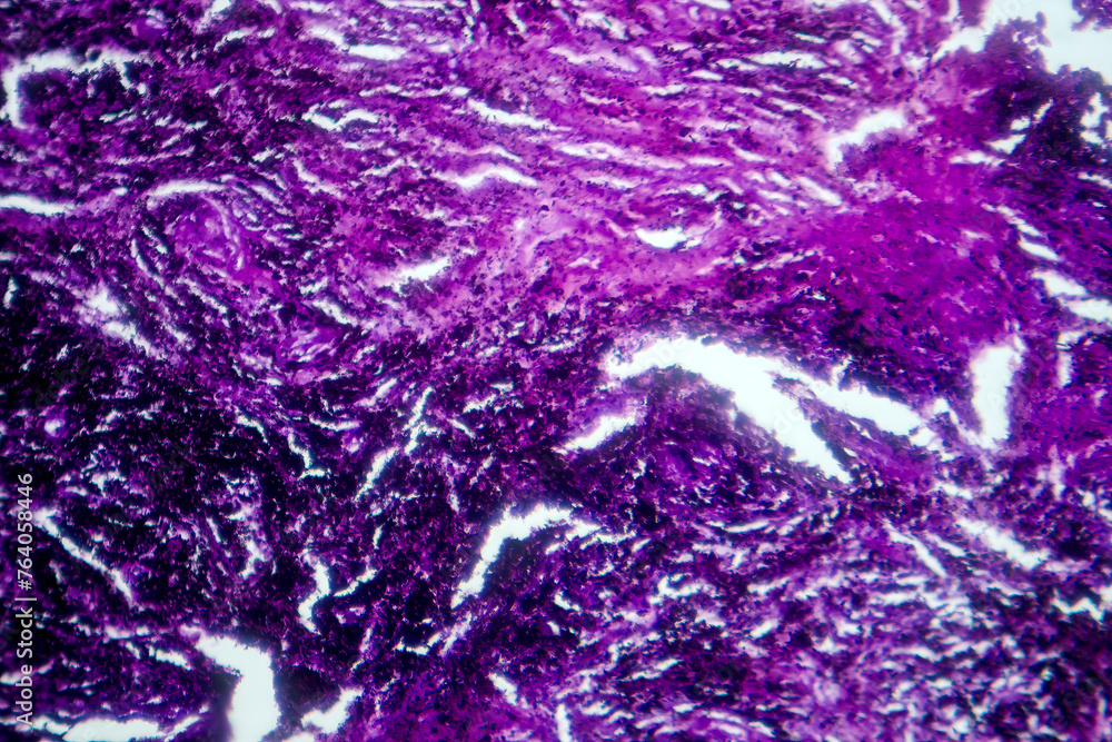 Photomicrograph of lung tissue with silicosis pathology under a ...