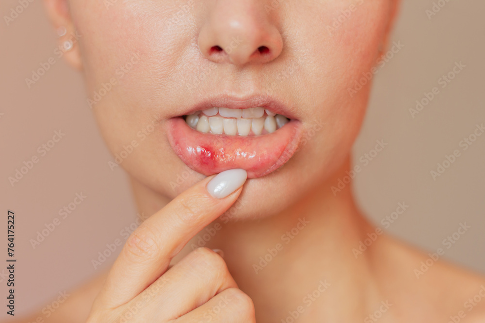 A young woman shows a close-up of a stomatitis ulcer in the acute stage ...