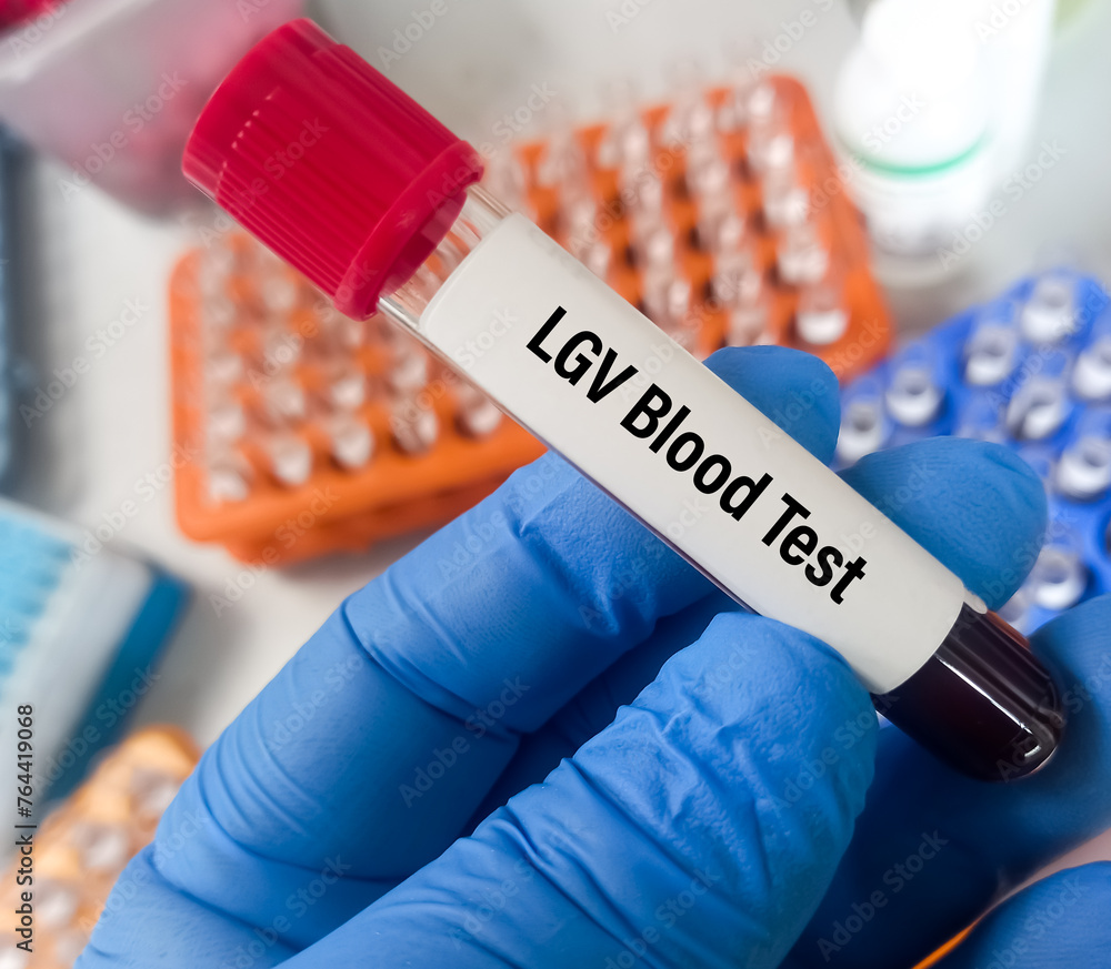 Blood sample for Lymphogranuloma Venereum (LGV) disease diagnosis test ...