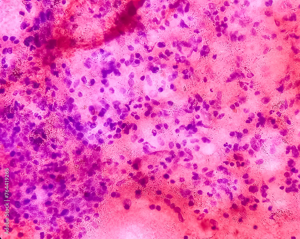 CT guided FNA from abduminal mass: Spindle cell neoplasm, smear show ...