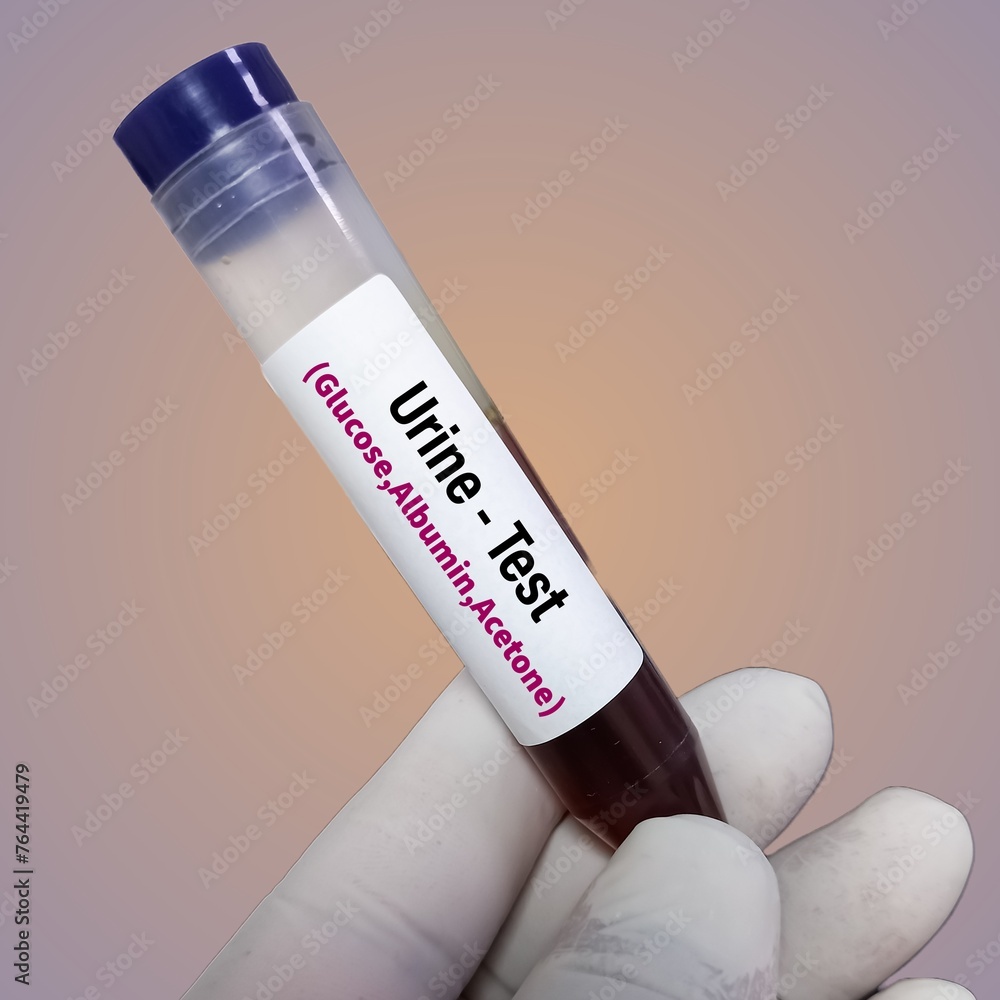 Urine sample in test vial for urine examination in hospital laboratory ...