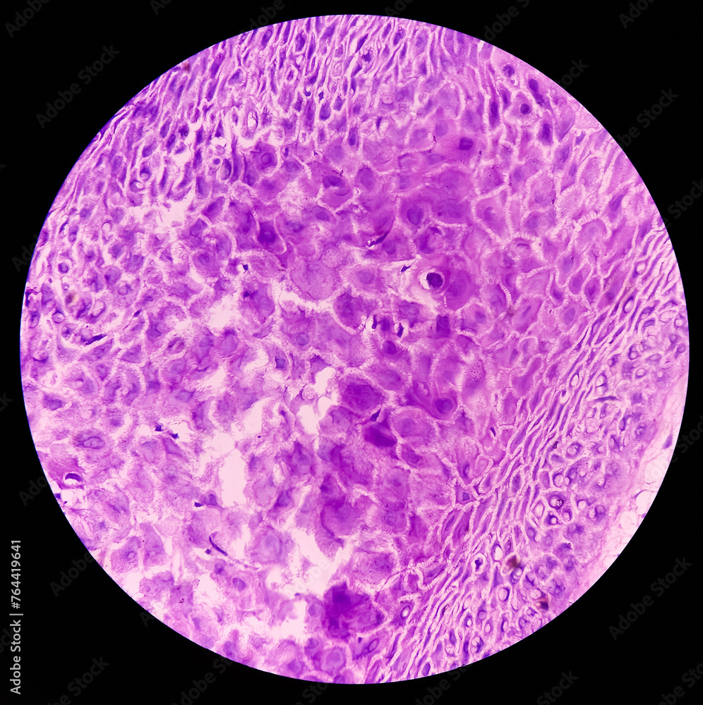 Squamous papilloma of maxilla to the human papilloma virus (HPV ...