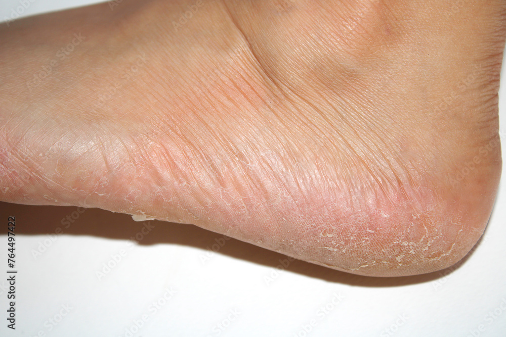 Peeling skin on the feet from excessive sweating in the heel area ...