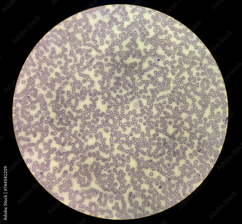 Acute thrombocytopenia and leukocytopenia with normal RBC analysed by ...