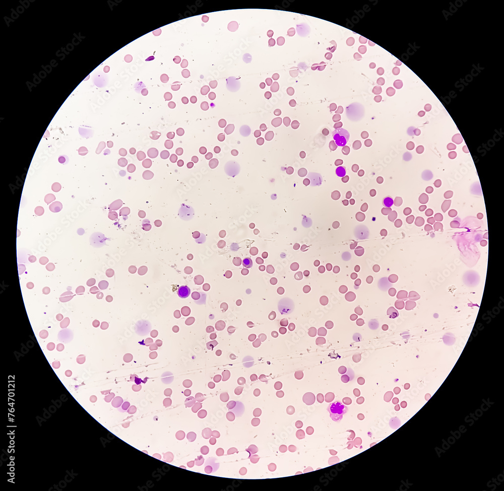 Photomicrograph of hematological slide showing severe anemia. Hemolytic ...