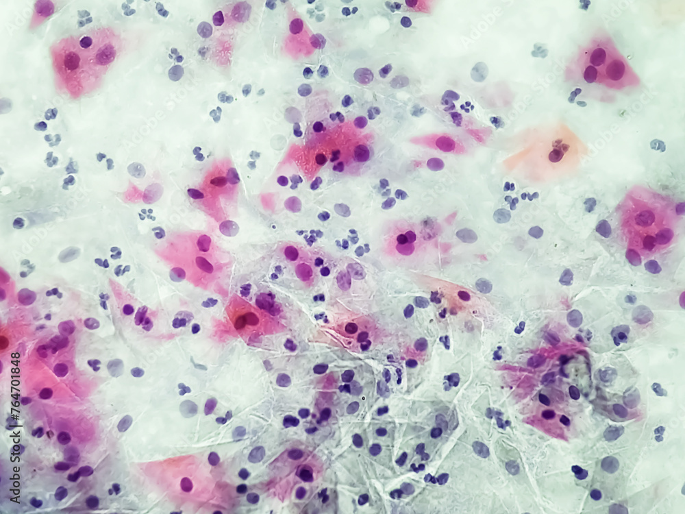 Gardnerella vaginalis infection pap smear under microscopy. Stock Photo ...