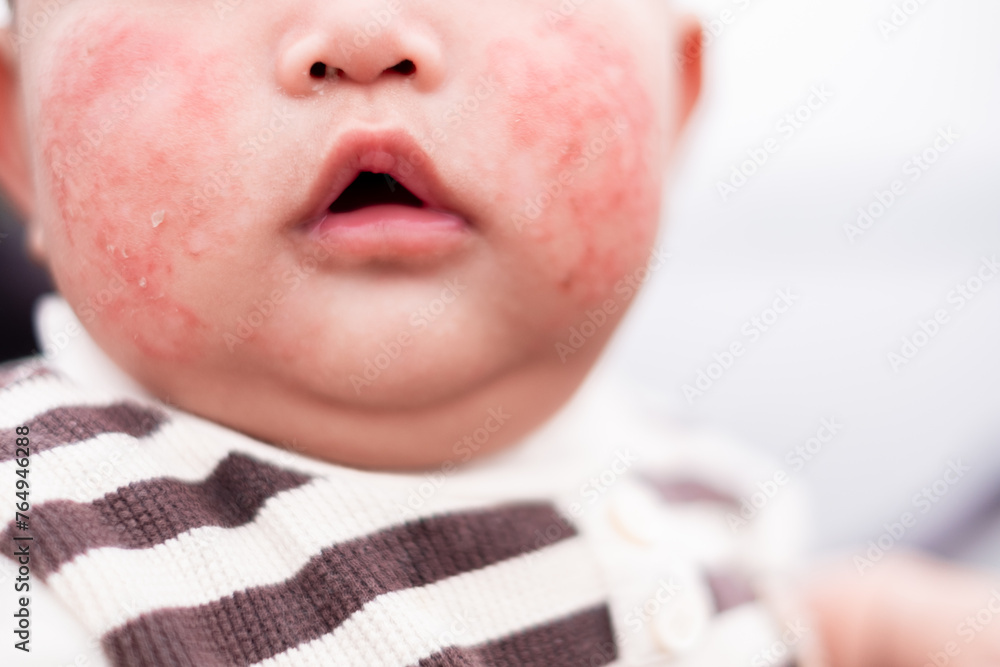 Red rash with Itching due dust or allergy on baby face, fungus, allergy ...