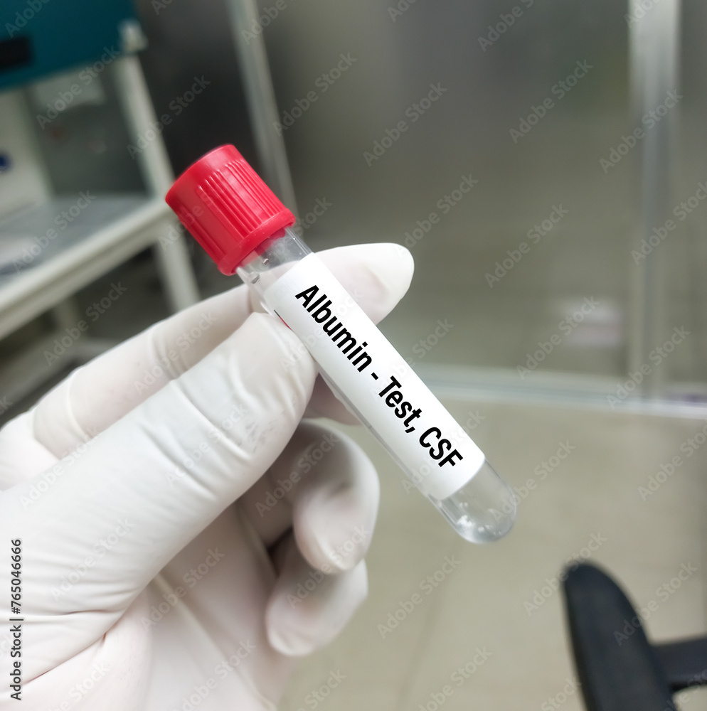CSF fluid for CSF albumin test, used to determine the levels of albumin ...