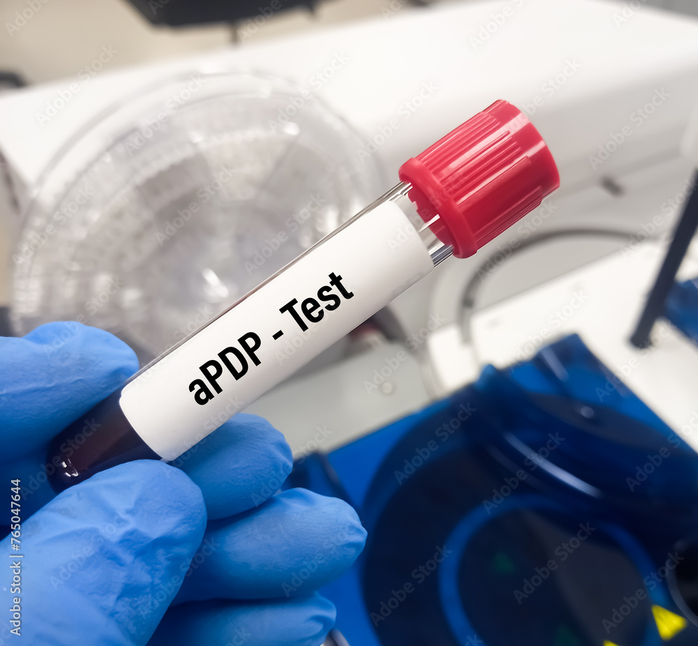 Blood sample for aPDP (Activated Human Cord Blood Platelet- Depleted ...