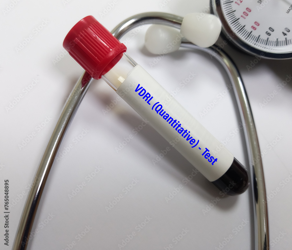 Blood sample for VDRL(Quantitative), RPR test, Syphilis screening test ...