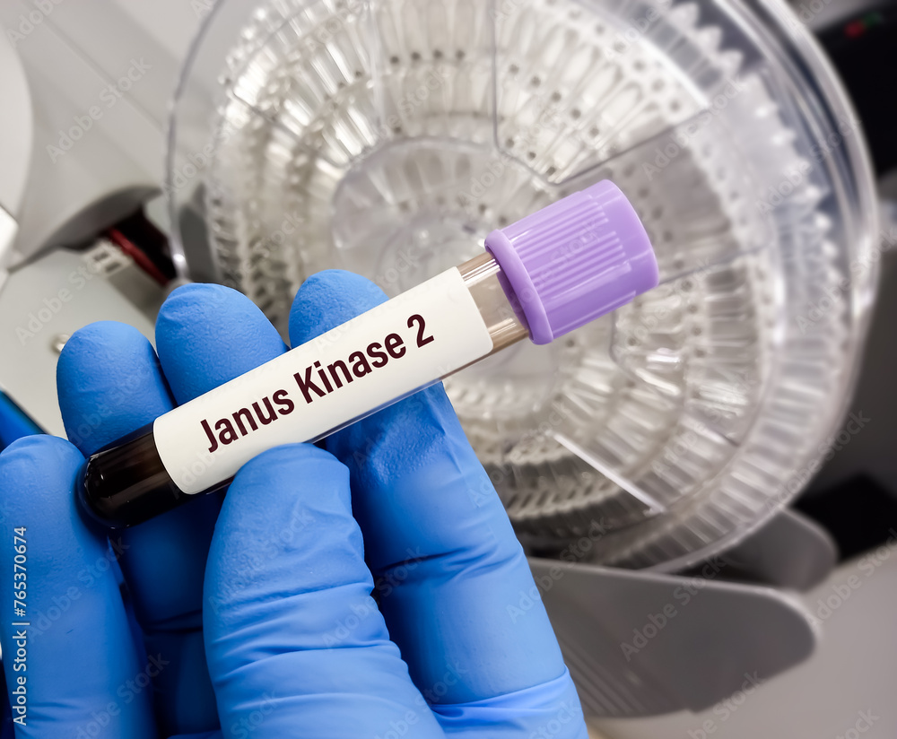 Blood sample for Janus Kinase 2(JAK2) gene test, to diagnose bone ...