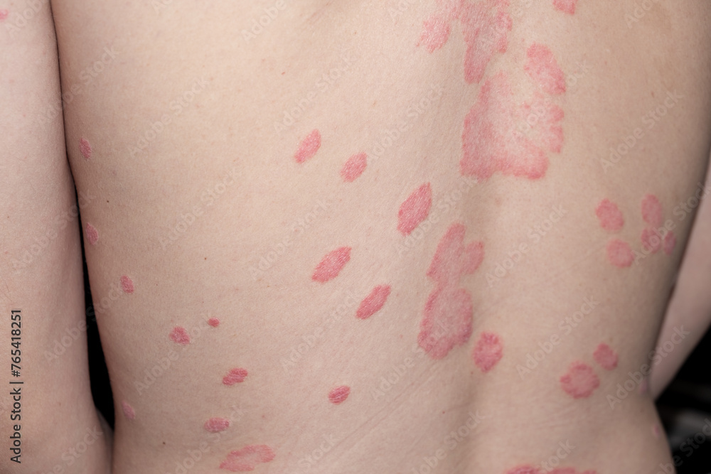 Psoriasis Vulgaris, skin patches are typically red, itchy, and scaly. Papules of chronic ...