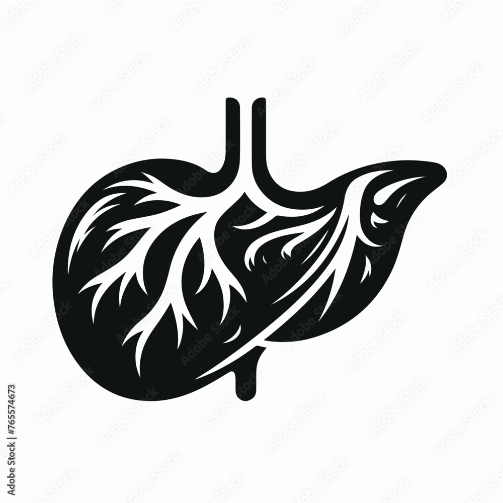 Gallstones in the gallbladder. Digestive organs. Liver. Stomach ...