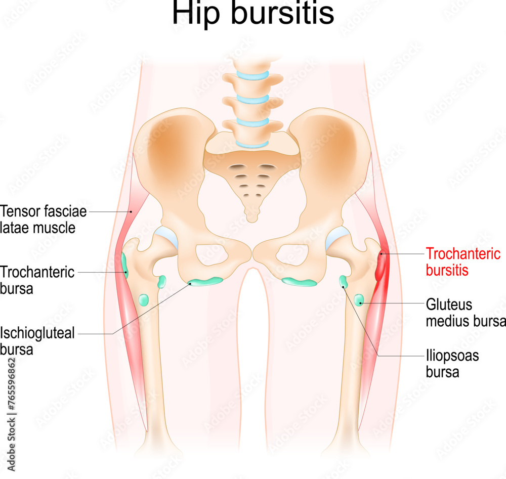 Hip bursitis. Muscles, Synovial bursas and bones of a human hip. Stock ...