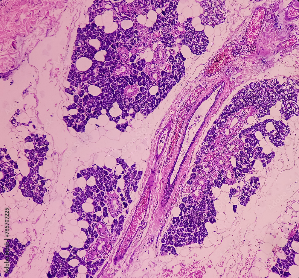 Salivary mucoid cyst. microscopic show parotid tissue, features of cyst ...