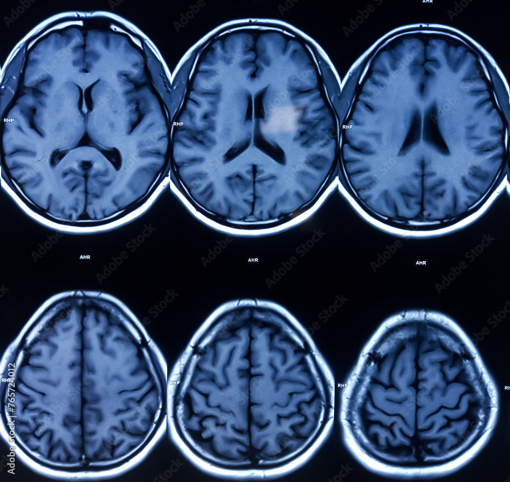 Magnetic resonance imaging (MRI) scan of the brain, showing brain ...