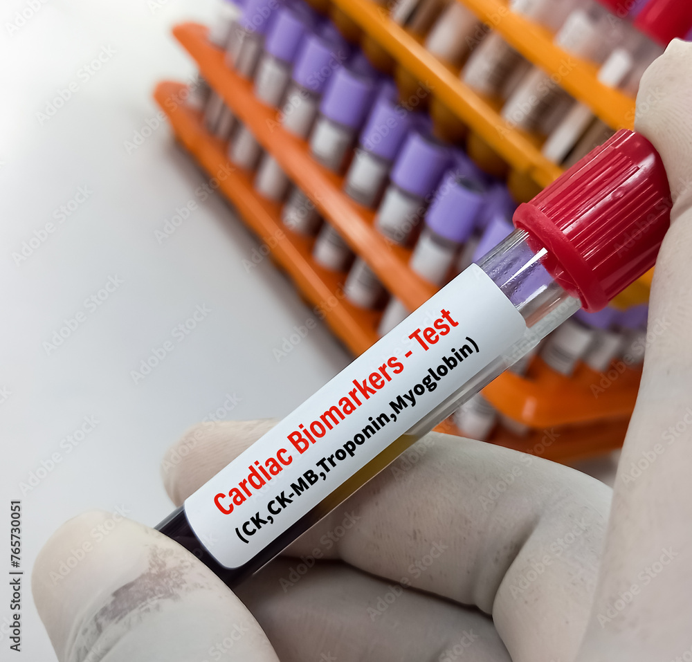 Blood sample for Cardiac biomarkers test to diagnosis of myocarditis ...