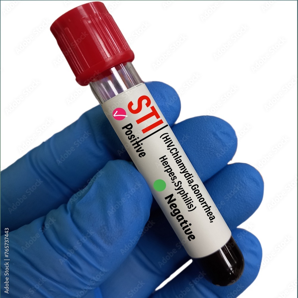 Scientist holds Blood sample for STI or STD (Sexually Transmitted ...