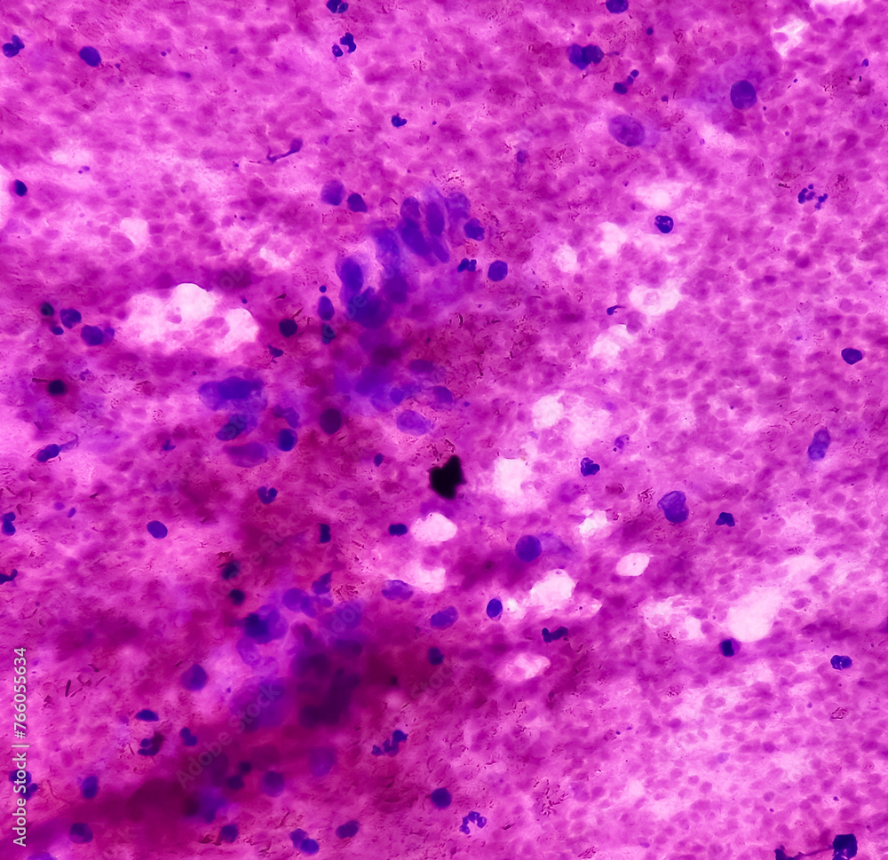 CT guided FNA from lung lesion, Chronic granulomatous inflammation (CGI ...