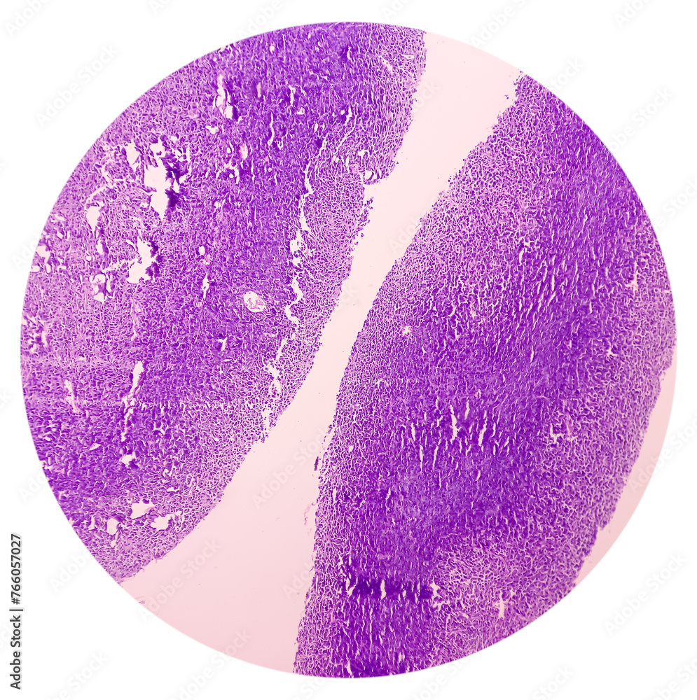 Soft tissue sarcoma, plasmacytoma, undifferentiated pleomorphic sarcoma ...