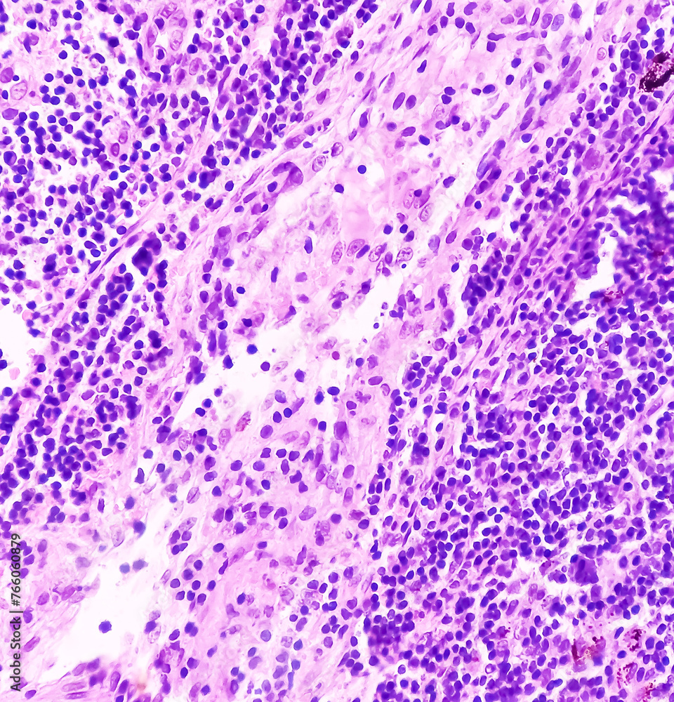 Lung cancer - adenocarcinoma, reactive change, lymph node show fibro ...
