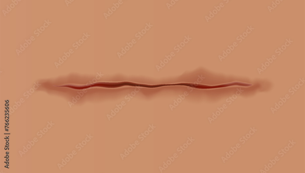 Healing wounds, skin scar, stitched gash and cut. Realistic surgical ...