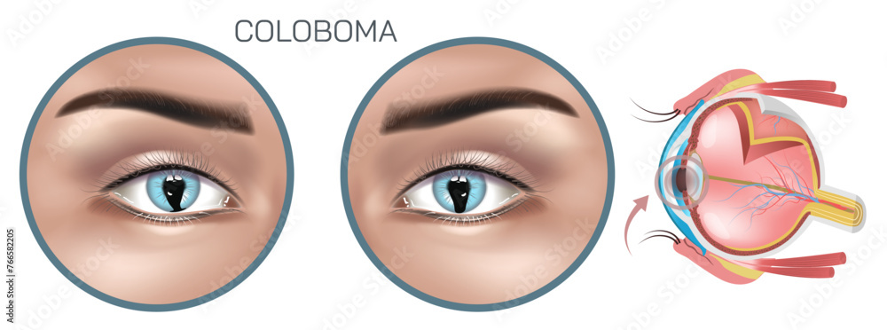 Coloboma is a congenital condition characterized by a gap or notch in ...