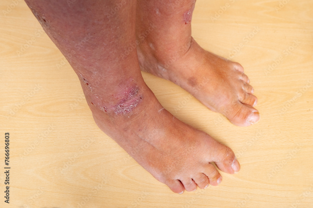 rash, hives, itchy skin on legs, inflammation and allergy, disease on ...