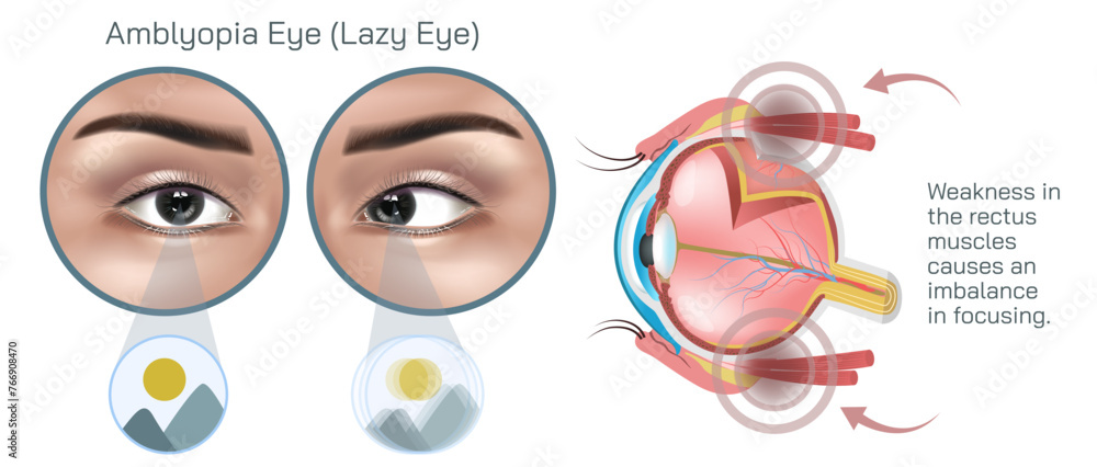 Amblyopia, often referred to as lazy eye is a condition characterized ...