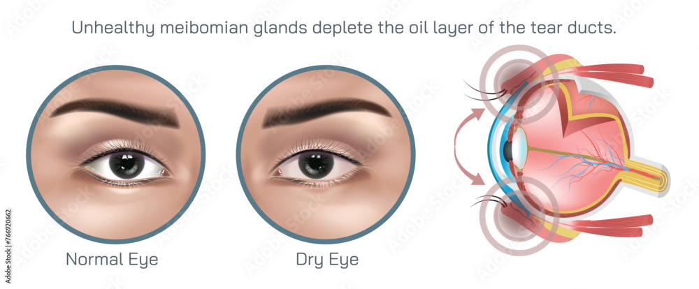 Dry eye syndrome, also known as dry eye disease is a common condition ...