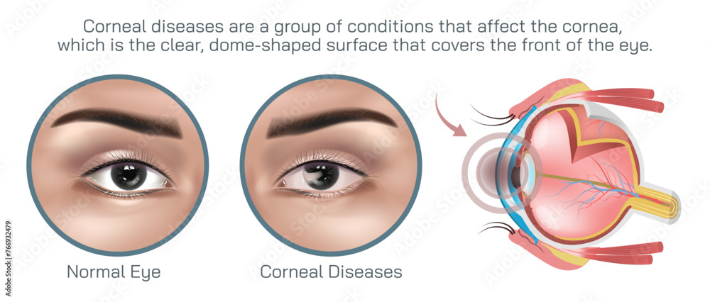Corneal conditions encompass a wide range of disorders and ...