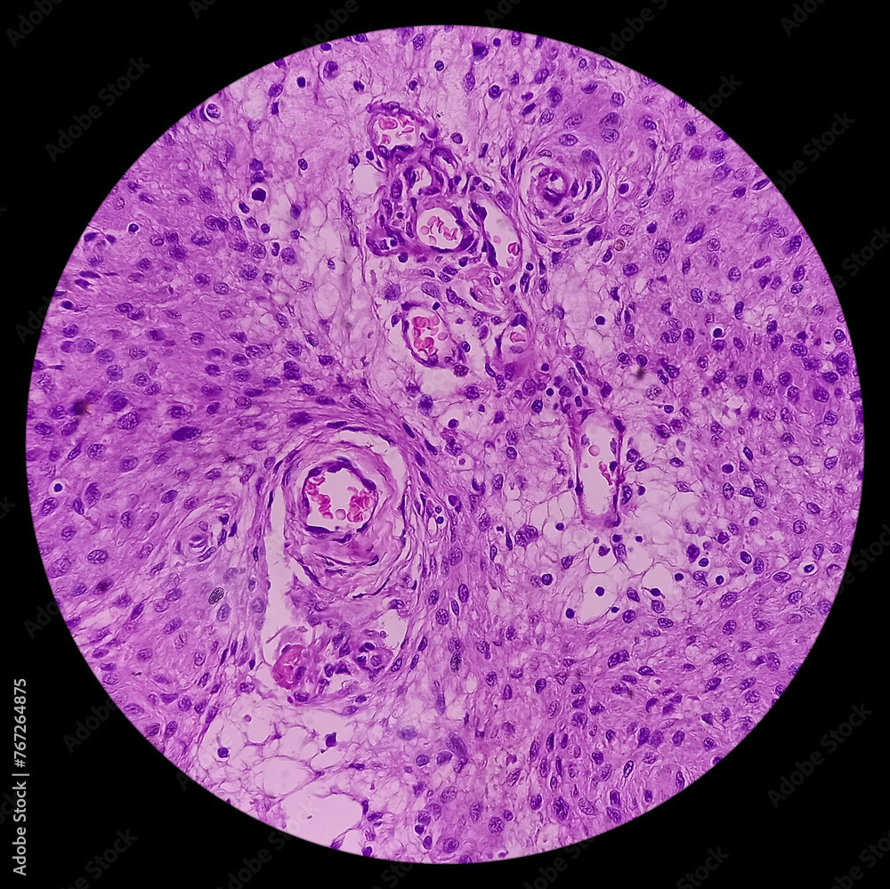 Parietal lesion(biopsy): Brain cancer, Meningioma, show neoplasm of ...