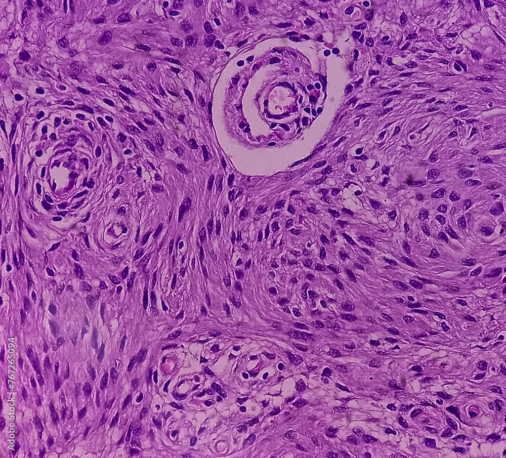 Parietal lesion(biopsy): Brain cancer, Meningioma, show neoplasm of ...