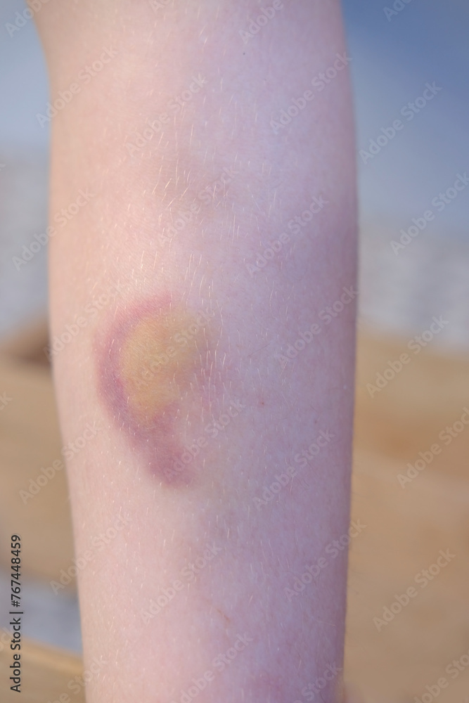 bruise on child's leg, wound healing process in child, Pediatric ...