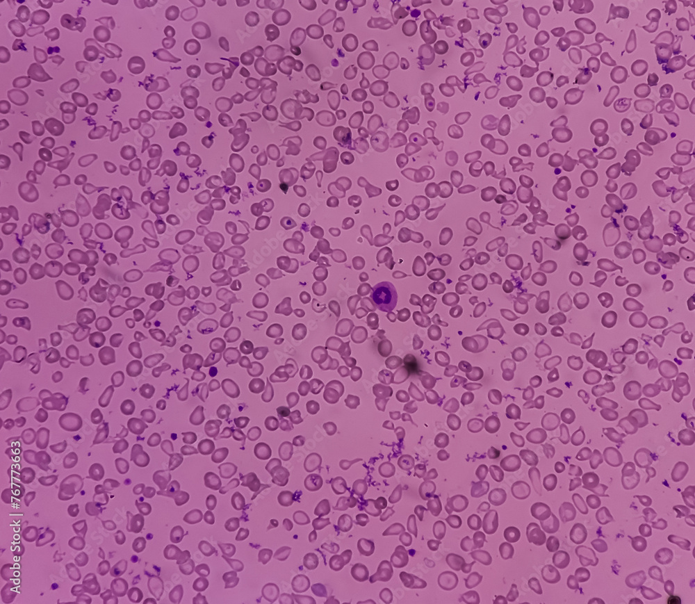 Blood smear, Hereditary hemolytic anemia. Hemoglobin E (HbE) disease ...