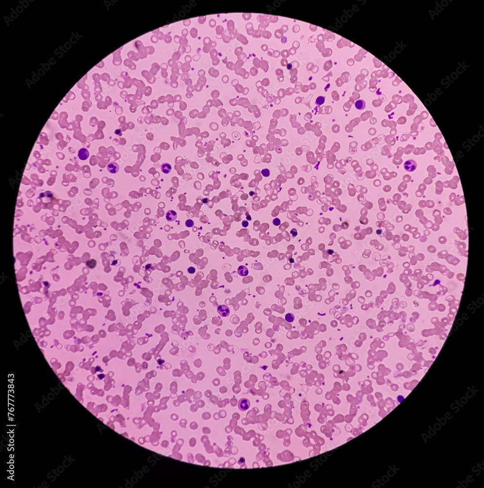 Blood smear, Hereditary hemolytic anemia. Hemoglobin E (HbE) disease ...