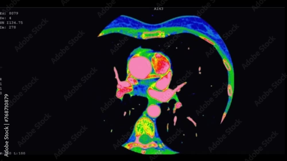 A computerized tomography CT coronary angiogram. Axial contrast of the ...