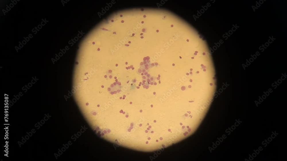 biopsy. biopsy results under a microscope. Human cancer cells under a ...