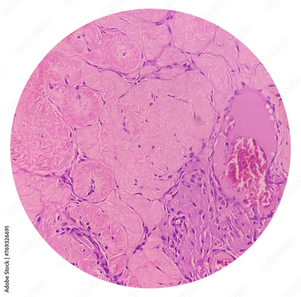 Uterus with adnexa (biopsy): Cervix show chronic inflamatory cells ...