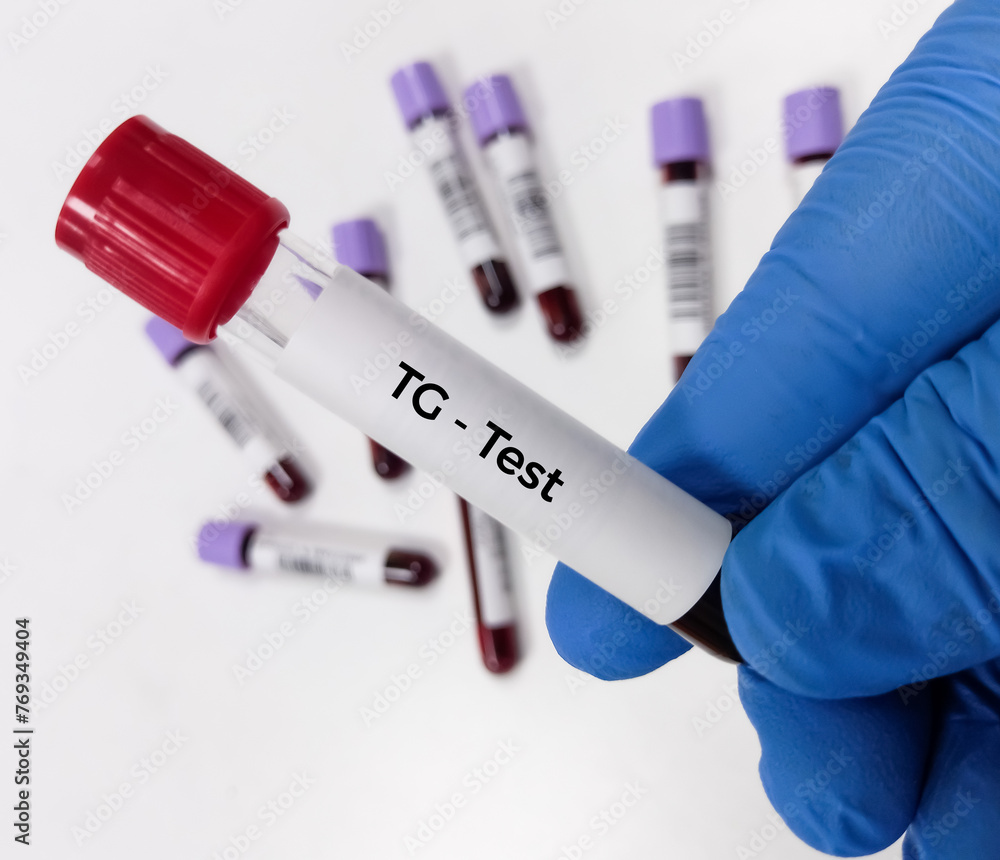 Blood sample for Serum Triglyceride (TG) test. Lipid profile. Fat test ...