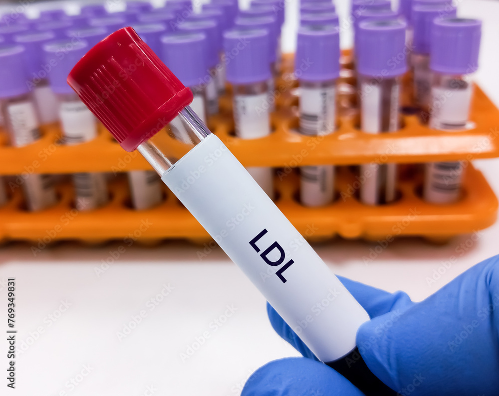 Blood sample for LDL-C (Low density lipoprotein cholesterol) test ...