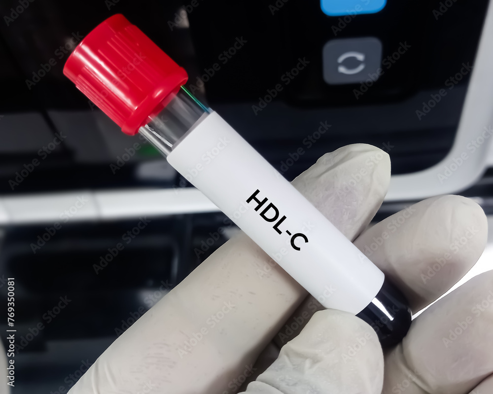 Blood sample for HDL-C (HDL cholesterol) test, cardiovascular risk ...